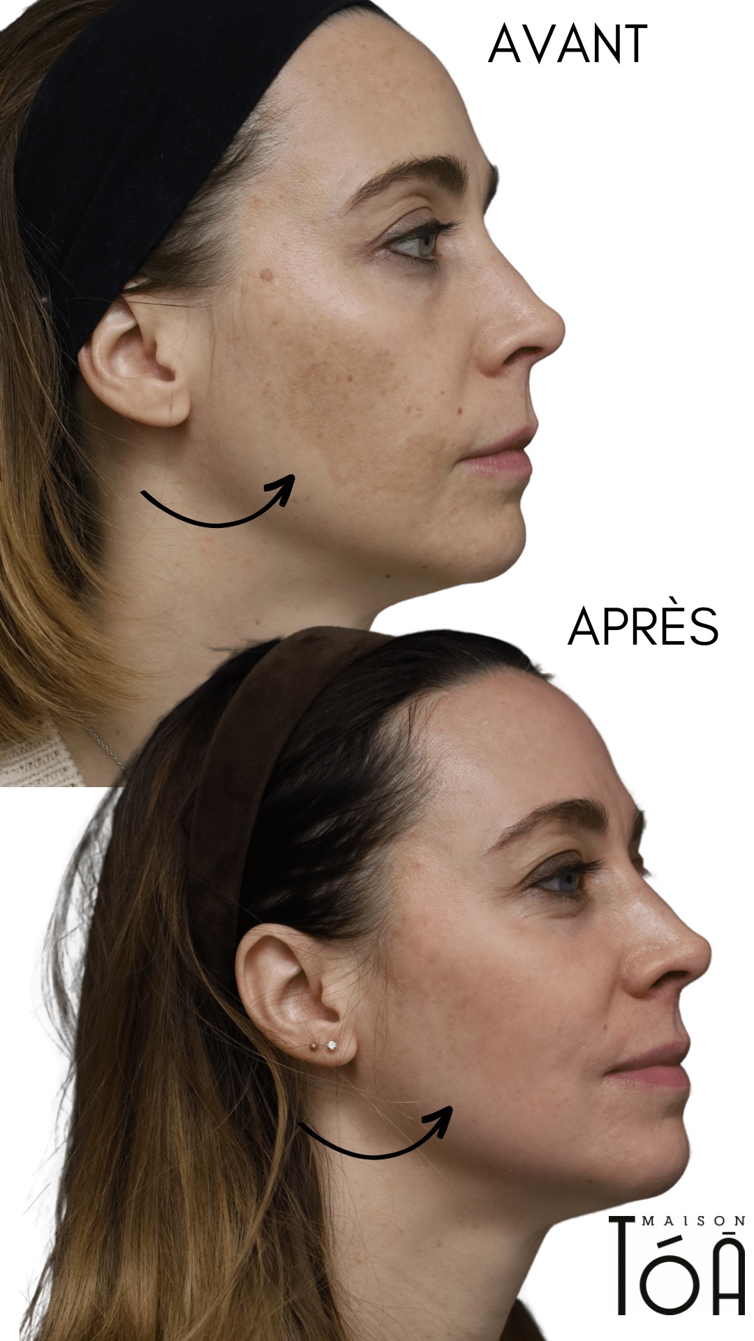 Laser pigmentaire: traitement des taches | Dr Alexandra Miles