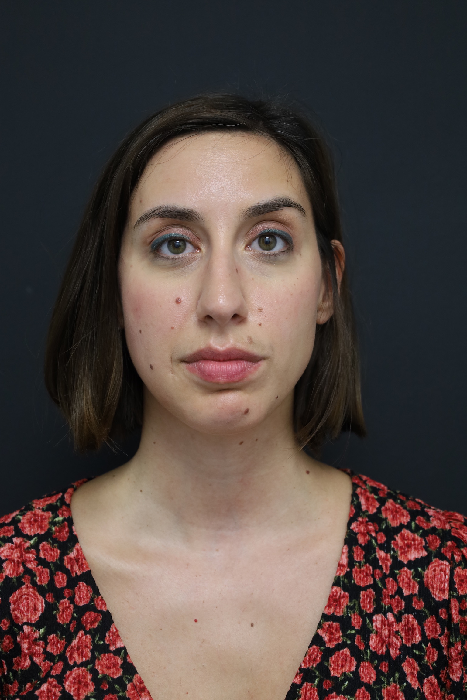 Cicatrice, vergeture et acné par laser CO2 fractionné