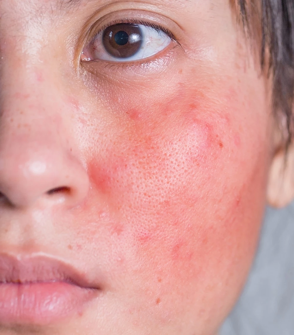 Eczéma - Médecine esthétique Lausanne